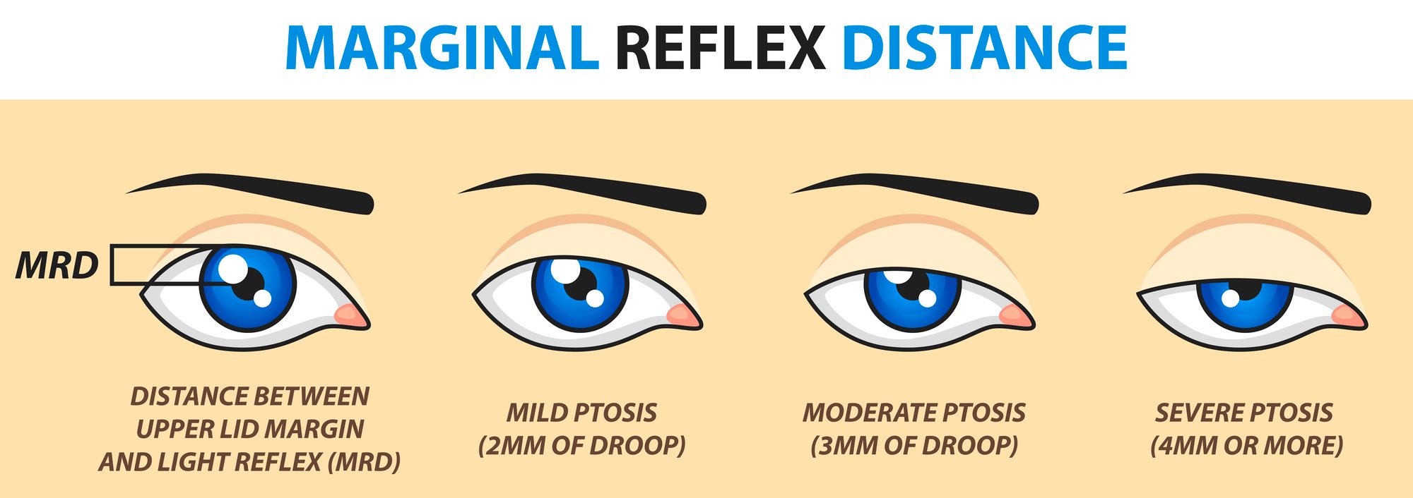 Non Incisional Ptosis Correction Surgery